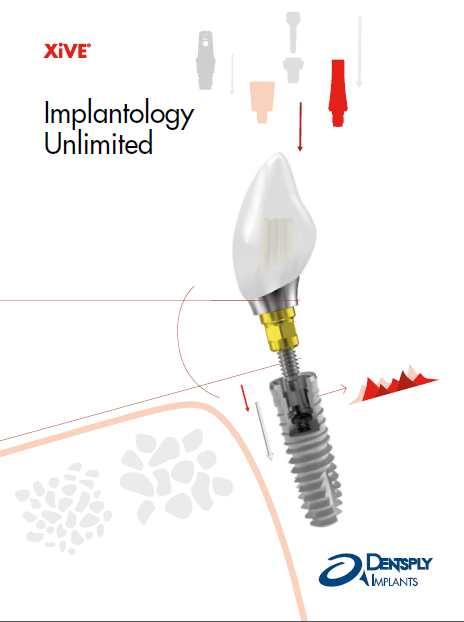 Dentsply Implants - XiVE® | FeedsFloor