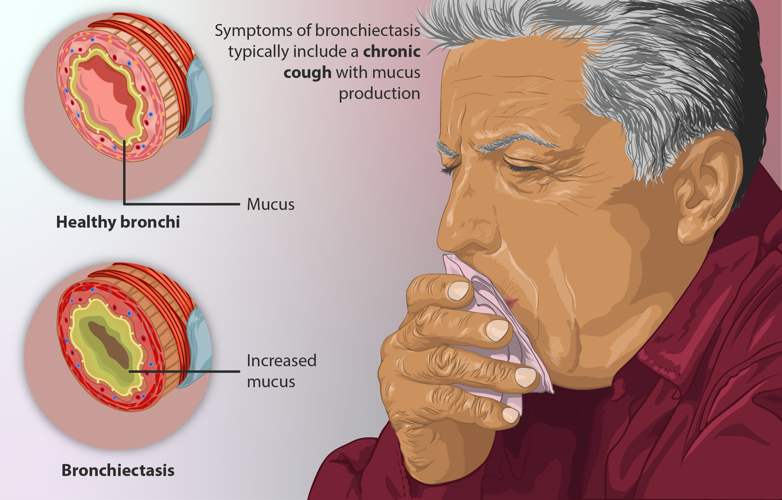 Bronchiectasis Drugs: Treatment Options for Managing this Chronic Lung ...