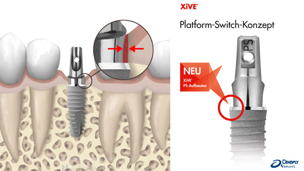 Dentsply Implants - XiVE® | FeedsFloor