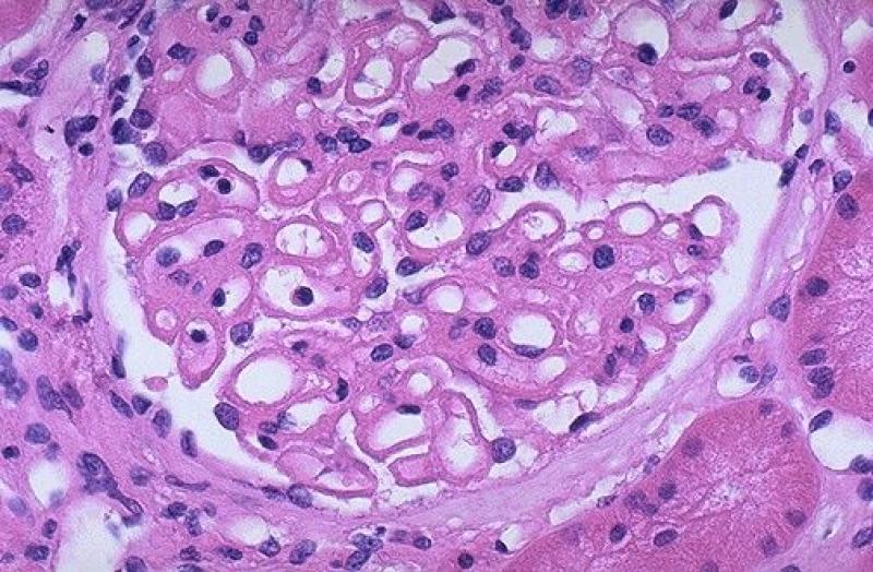 Advances in Idiopathic Membranous Nephropathy Treatment Options and ...