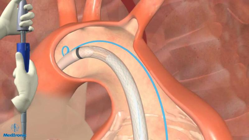 Advancements in Endovascular Aneurysm Repair Technology and Procedures ...